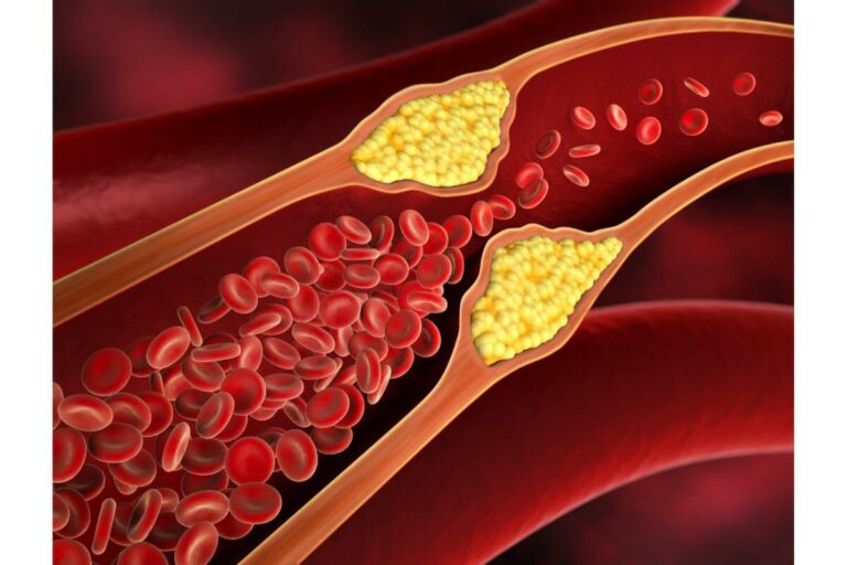 Arteriosklerose Leitfaden | Gefässklinik Dr. Tsantilas