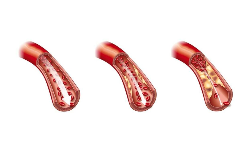 Arteriosklerose Leitfaden | Gefässklinik Dr. Tsantilas